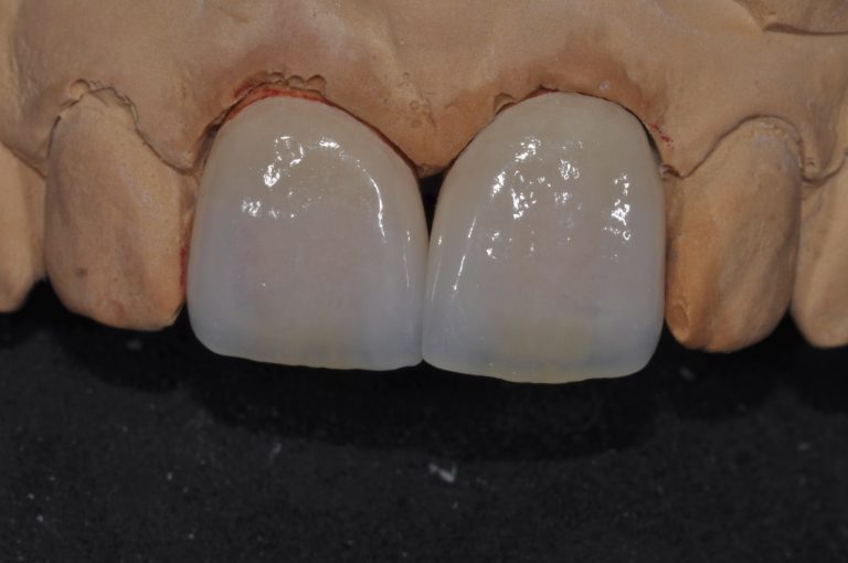 Teeth Veneers Sydney | Sydney Dental Veneers | sydneydentalveneer.com.au