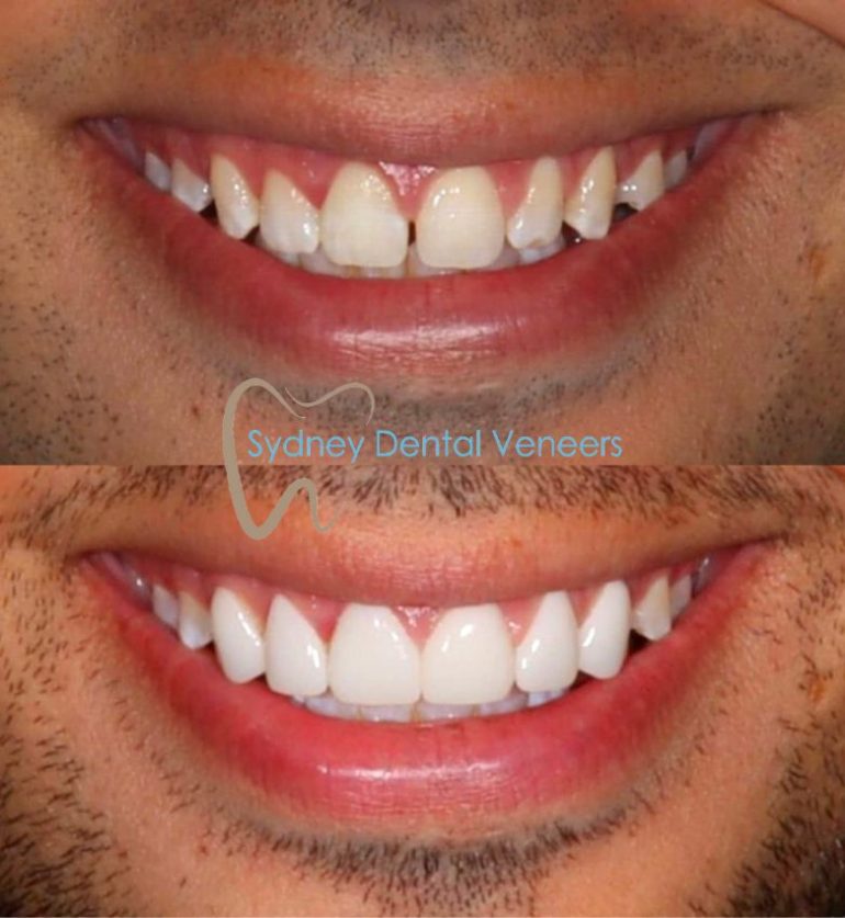 Veneers Before & Afters | Real Life Smile Transformations