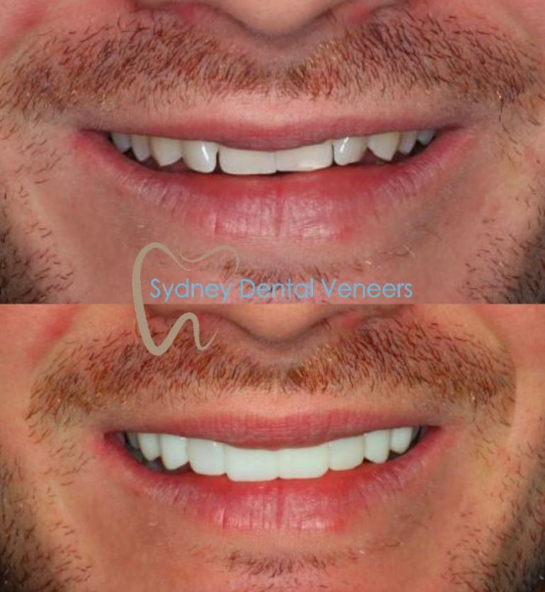 Veneers Before & Afters | Real Life Smile Transformations