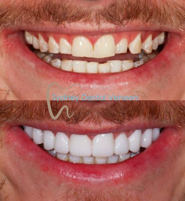 Veneers Before & Afters | Real Life Smile Transformations
